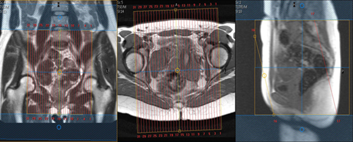 MR Female Pelvis / Soft Tissue Pelvis W/WO BODY Protocol | OHSU